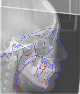 DIP Ceph｜AIが変える矯正歯科の未来