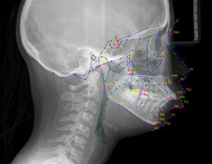 DIP Ceph｜AIが変える矯正歯科の未来